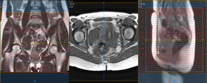 MR Defecography WO BODY Protocol | OHSU